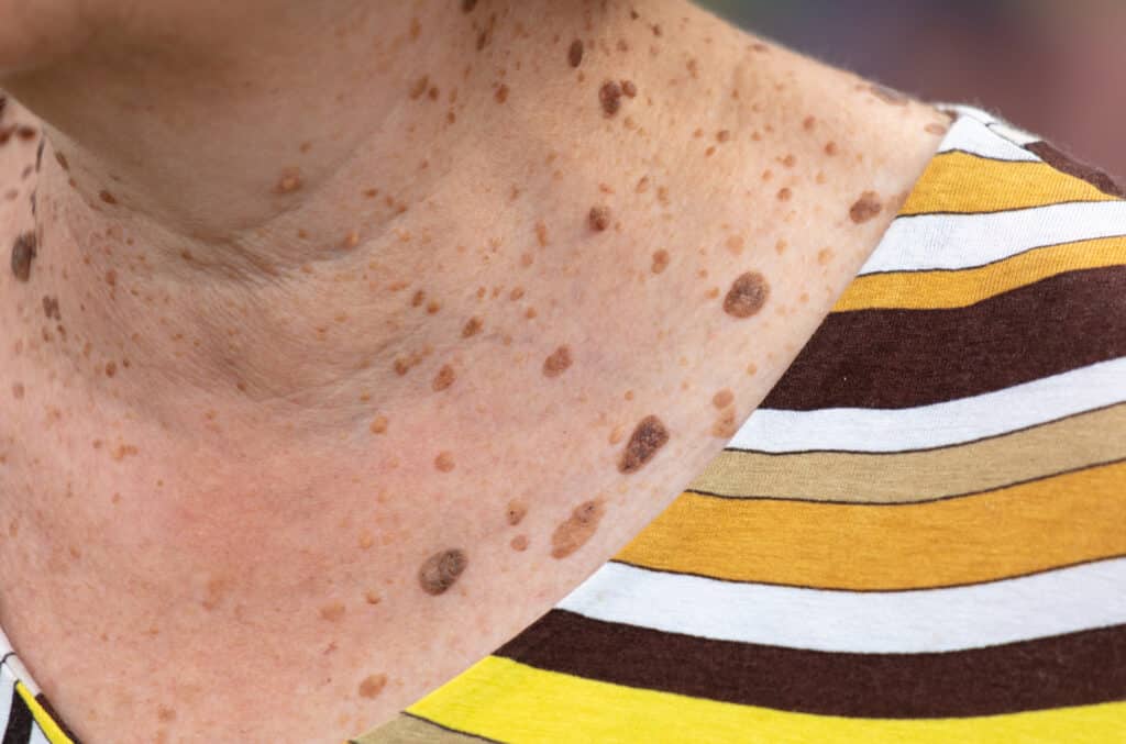 Tache Marron sur la Peau : Photos, Causes et Traitement