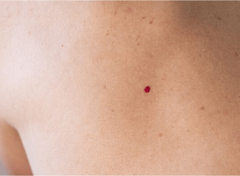 Angiome Rubis : Causes, Traitements et Photos – Tout savoir