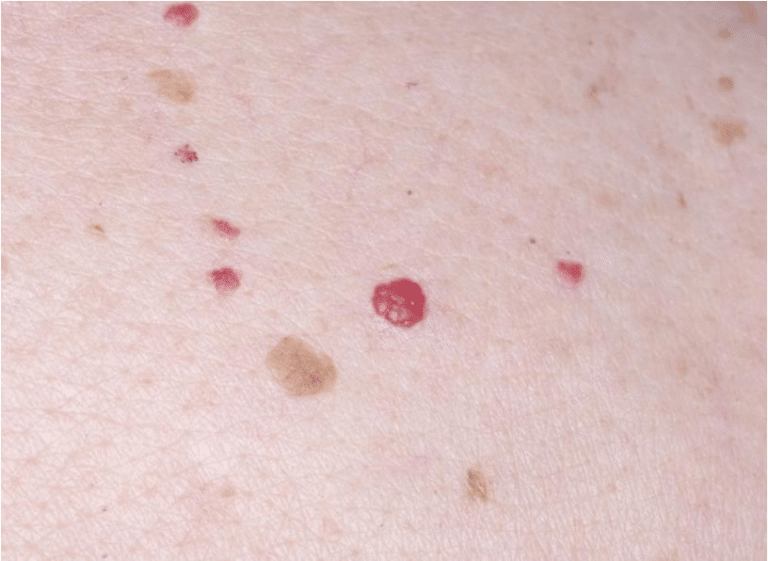 Angiome Rubis : Causes, Traitements et Photos – Tout savoir