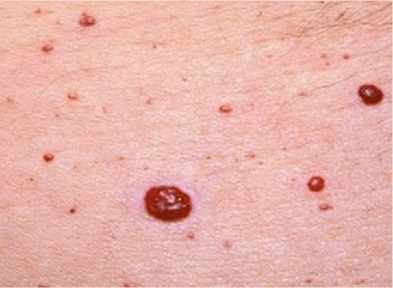 Angiome Rubis : Causes, Traitements et Photos – Tout savoir