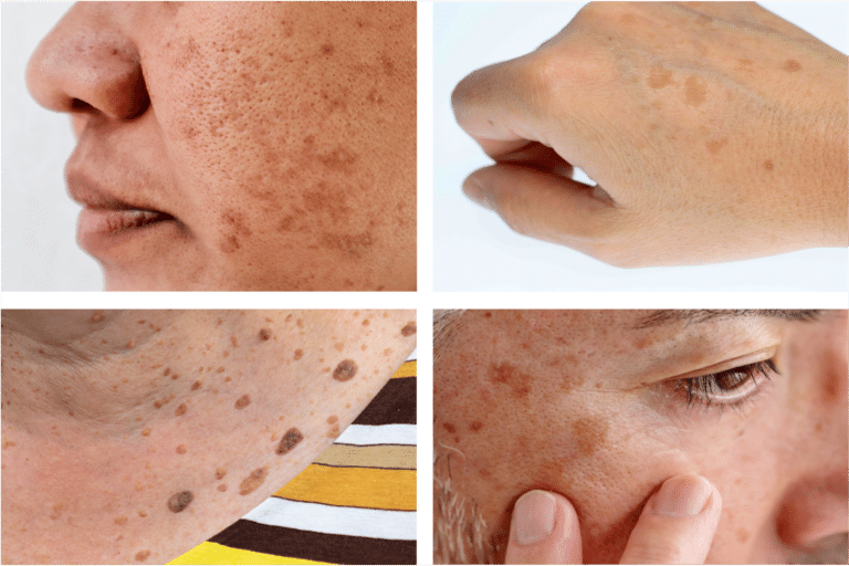 Tache Marron sur la Peau : Photos, Causes et Traitement