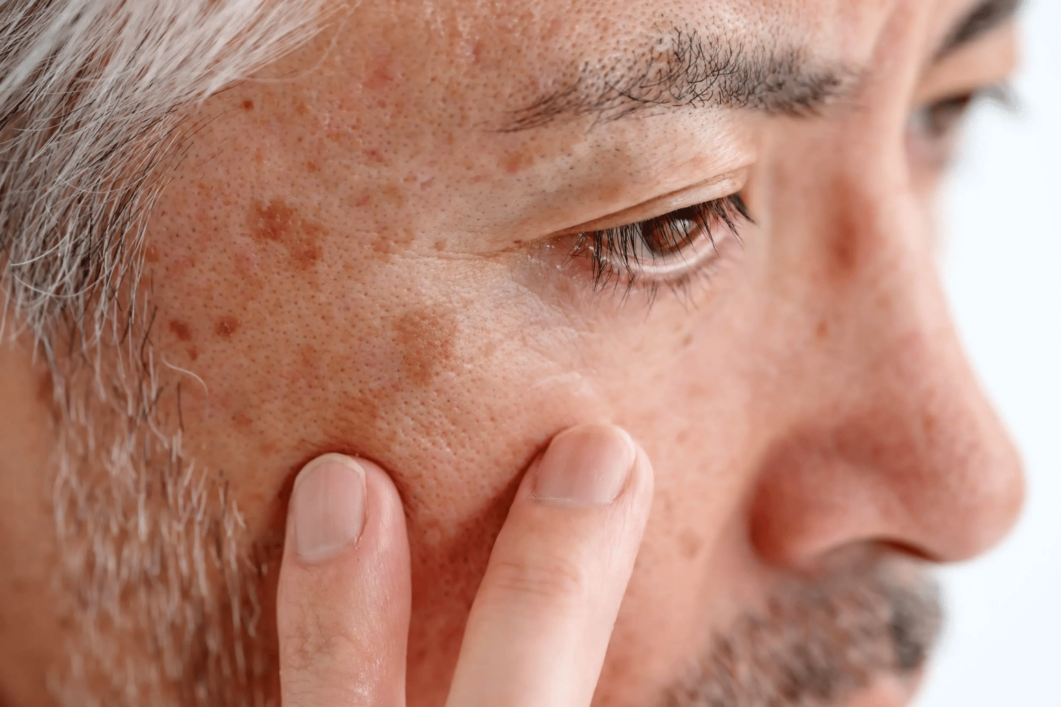 Tache Marron sur la Peau : Photos, Causes et Traitement