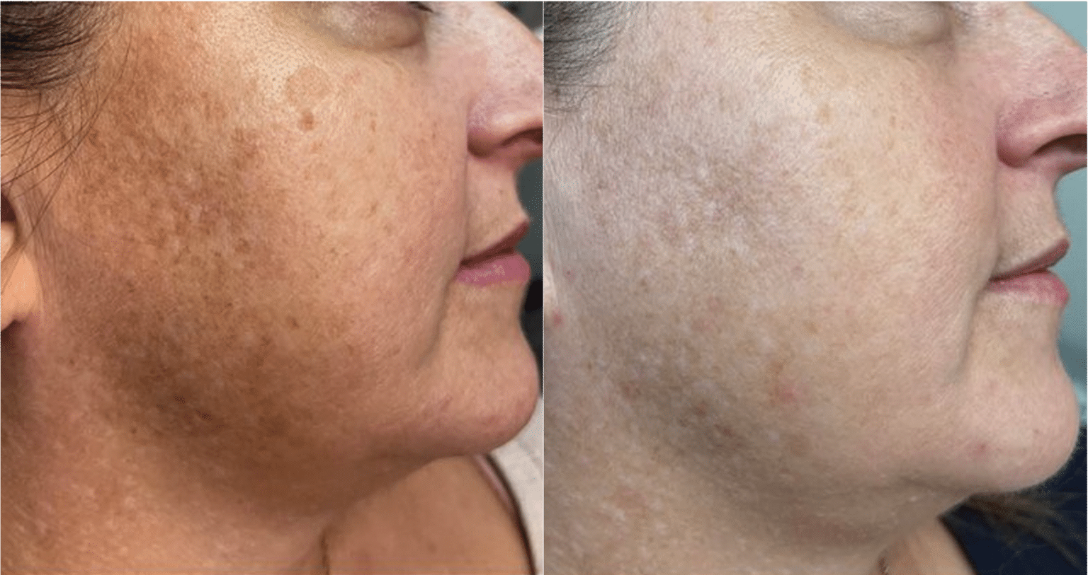 Laser Taches Brunes : Résultats Avant et Après | Skin Marceau