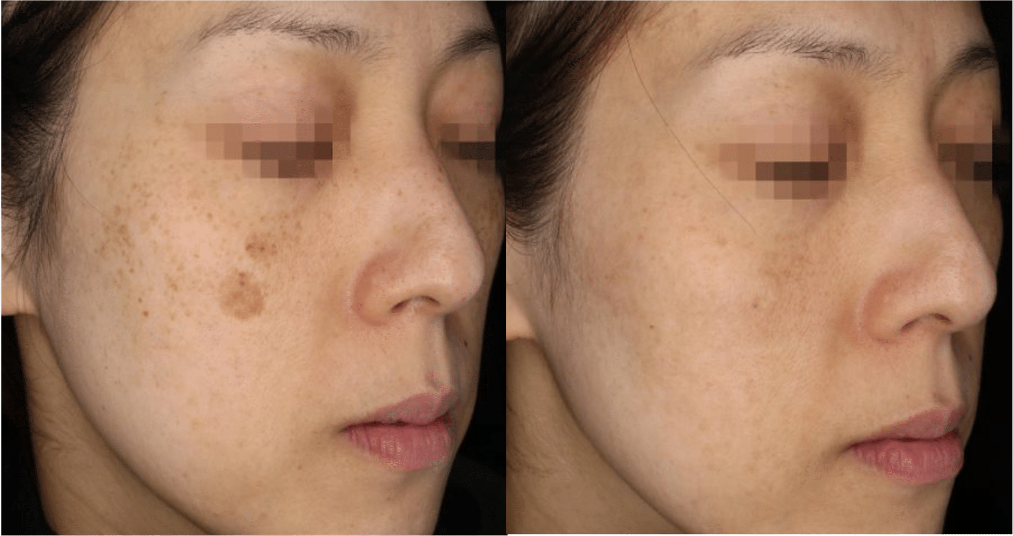 Laser Taches Brunes : Résultats Avant et Après | Skin Marceau