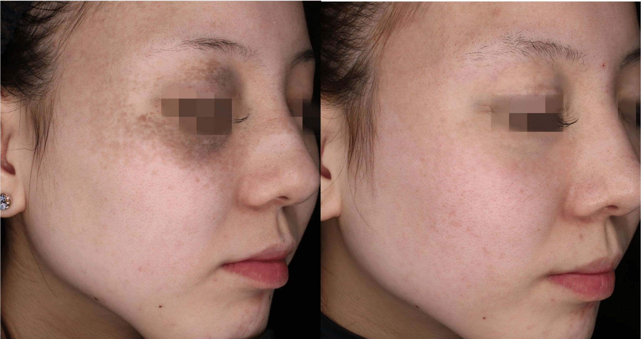 Laser Taches Brunes : Résultats Avant et Après | Skin Marceau