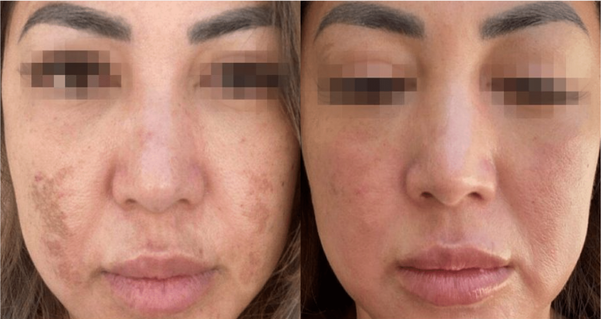 Laser Taches Brunes : Résultats Avant et Après | Skin Marceau