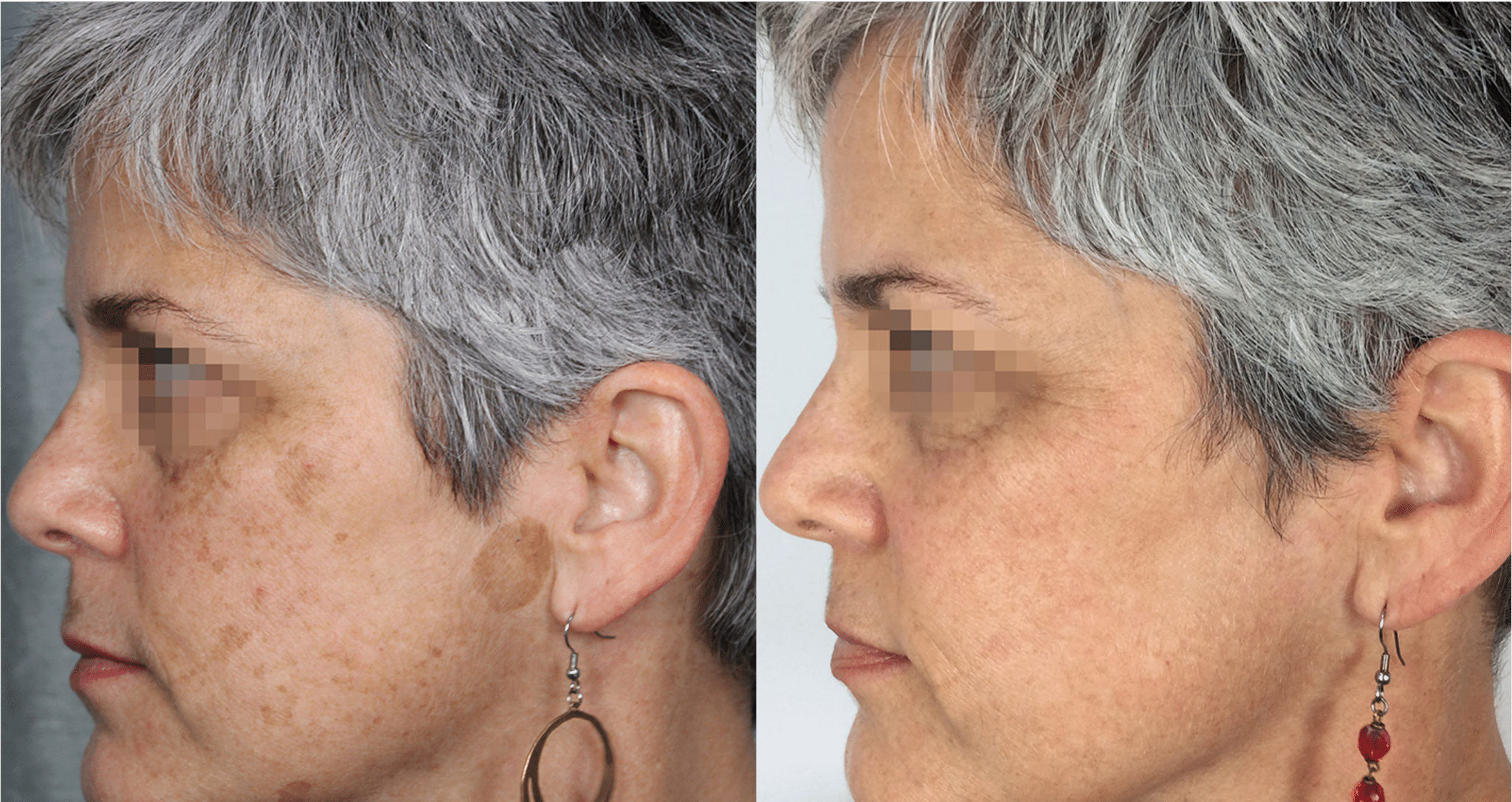 Laser Taches Brunes : Résultats Avant et Après | Skin Marceau